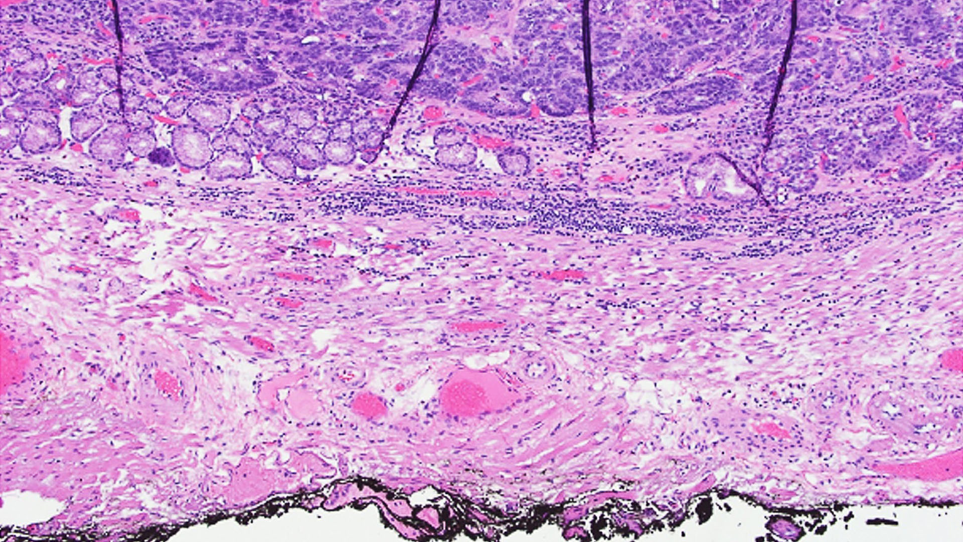 Deep Tumors Fully Resected with Endoscopic Submucosal Dissection - NYU ...