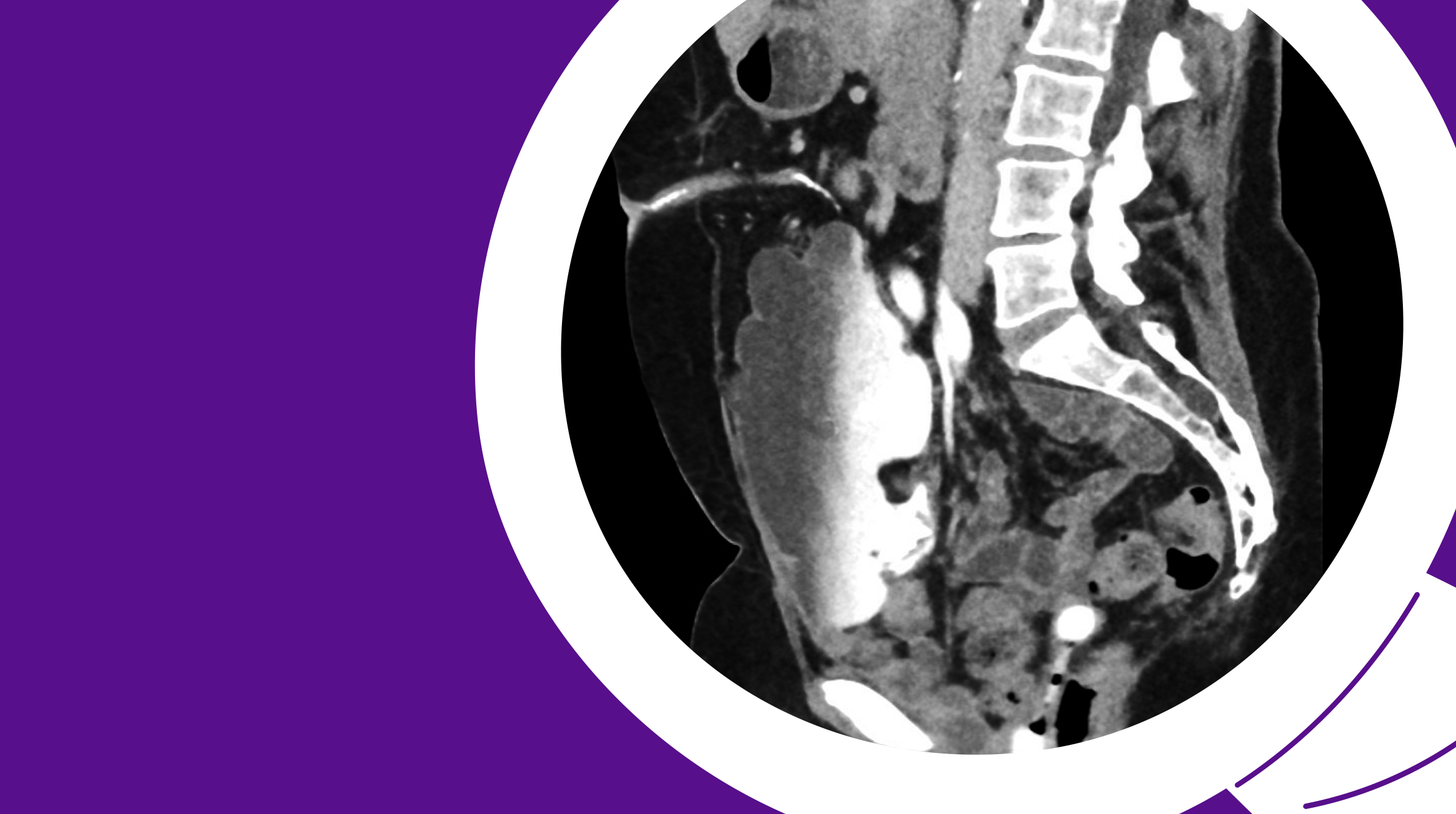 When Sacrocolpopexy Is the Best Choice for Post-Cystectomy Prolapse ...