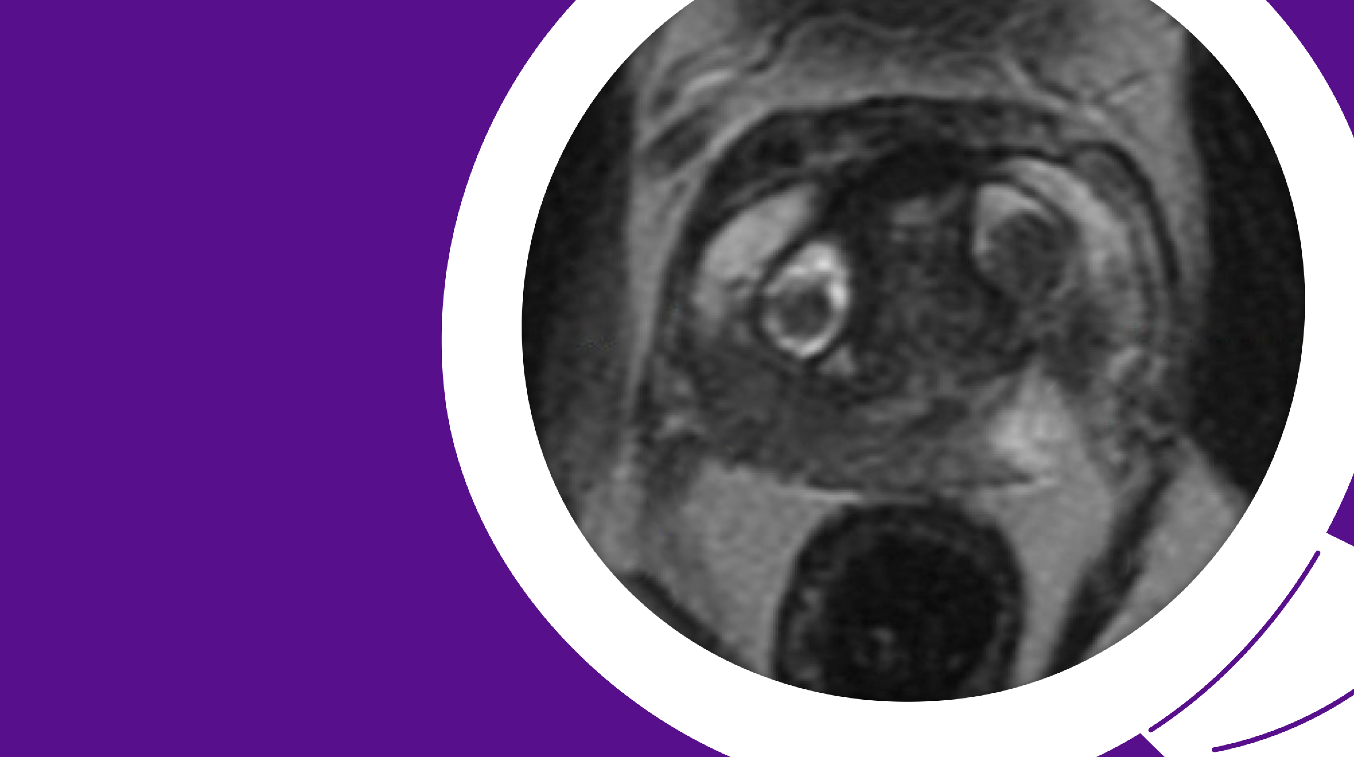 Four Steps in Shared Decision-Making for Prostate Cancer - NYU Langone ...