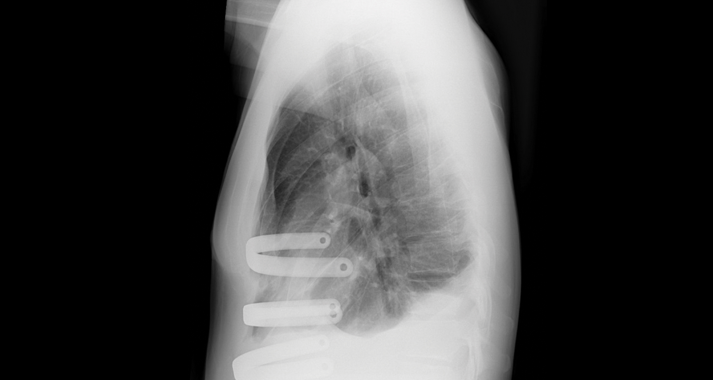 Nuss Procedure for Complex Pectus Excavatum| NYU Langone Health ...
